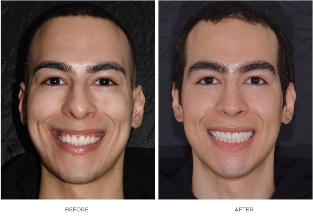Innovative Invisalign Treatment in NYC - Dr. Lena Dentistry