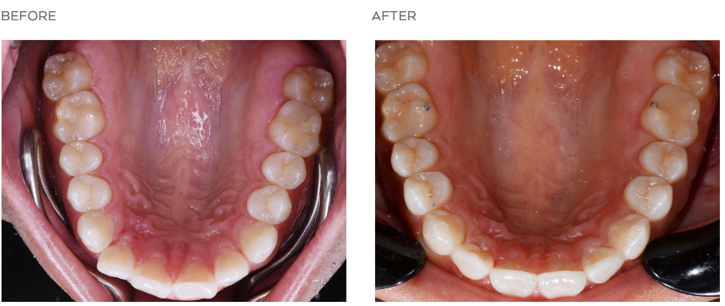 Innovative Invisalign Treatment in NYC - Dr. Lena Dentistry