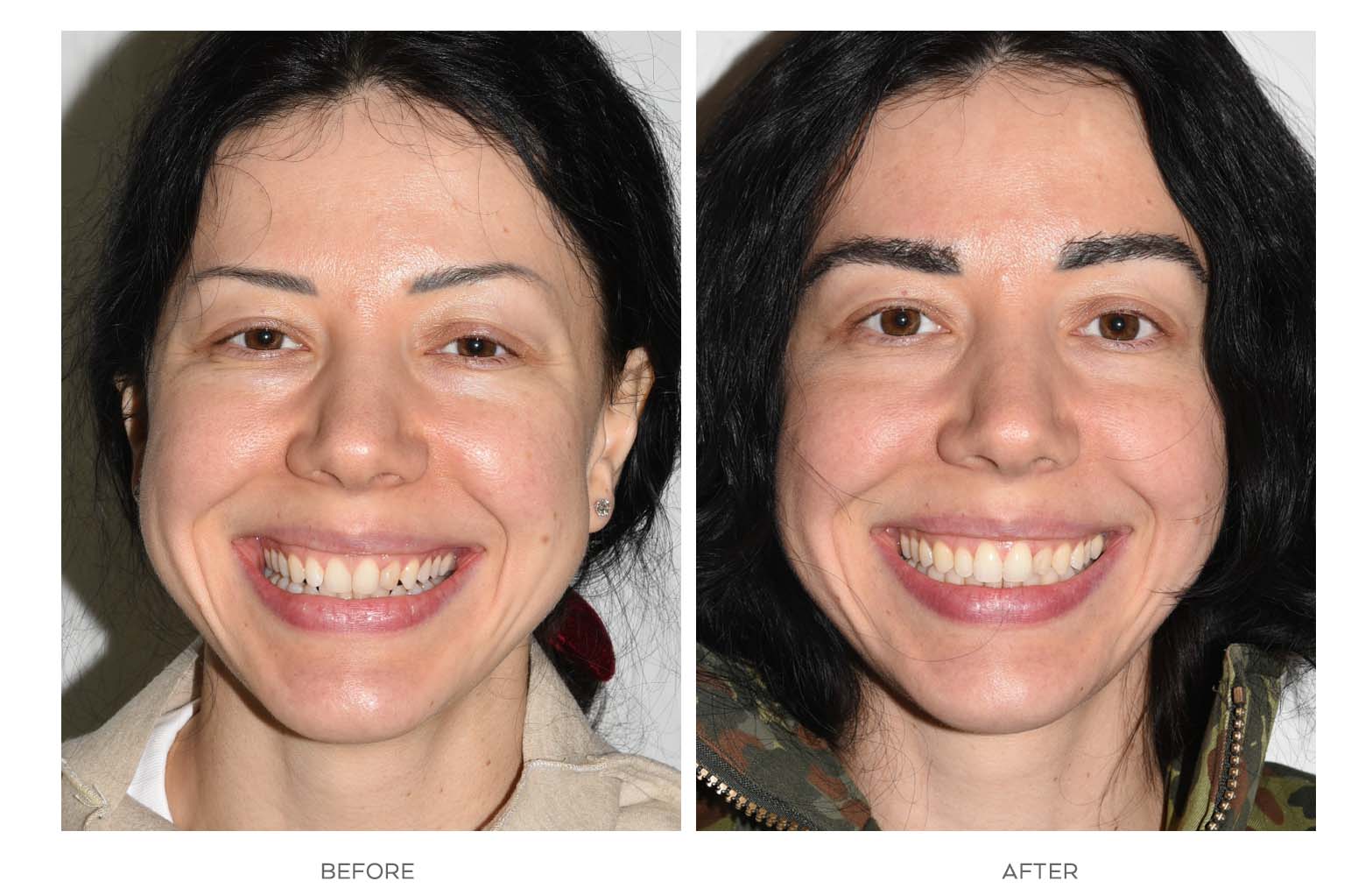 Best Invisalign in NYC | Artistry in Dentistry