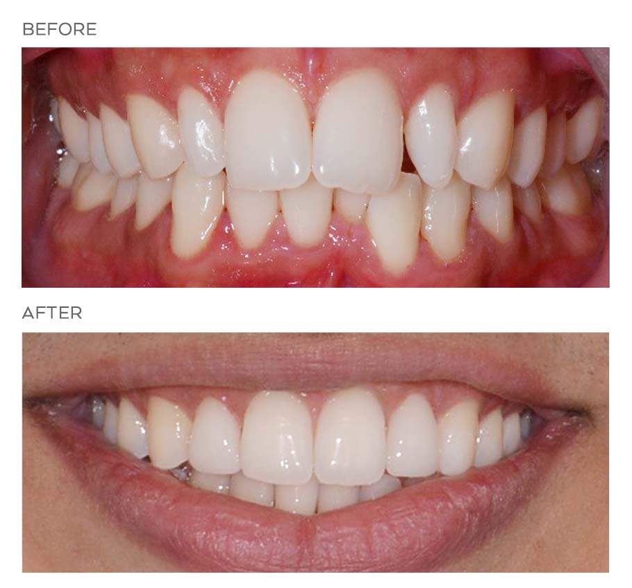 Best Invisalign in NYC | No Extractions or IPR
