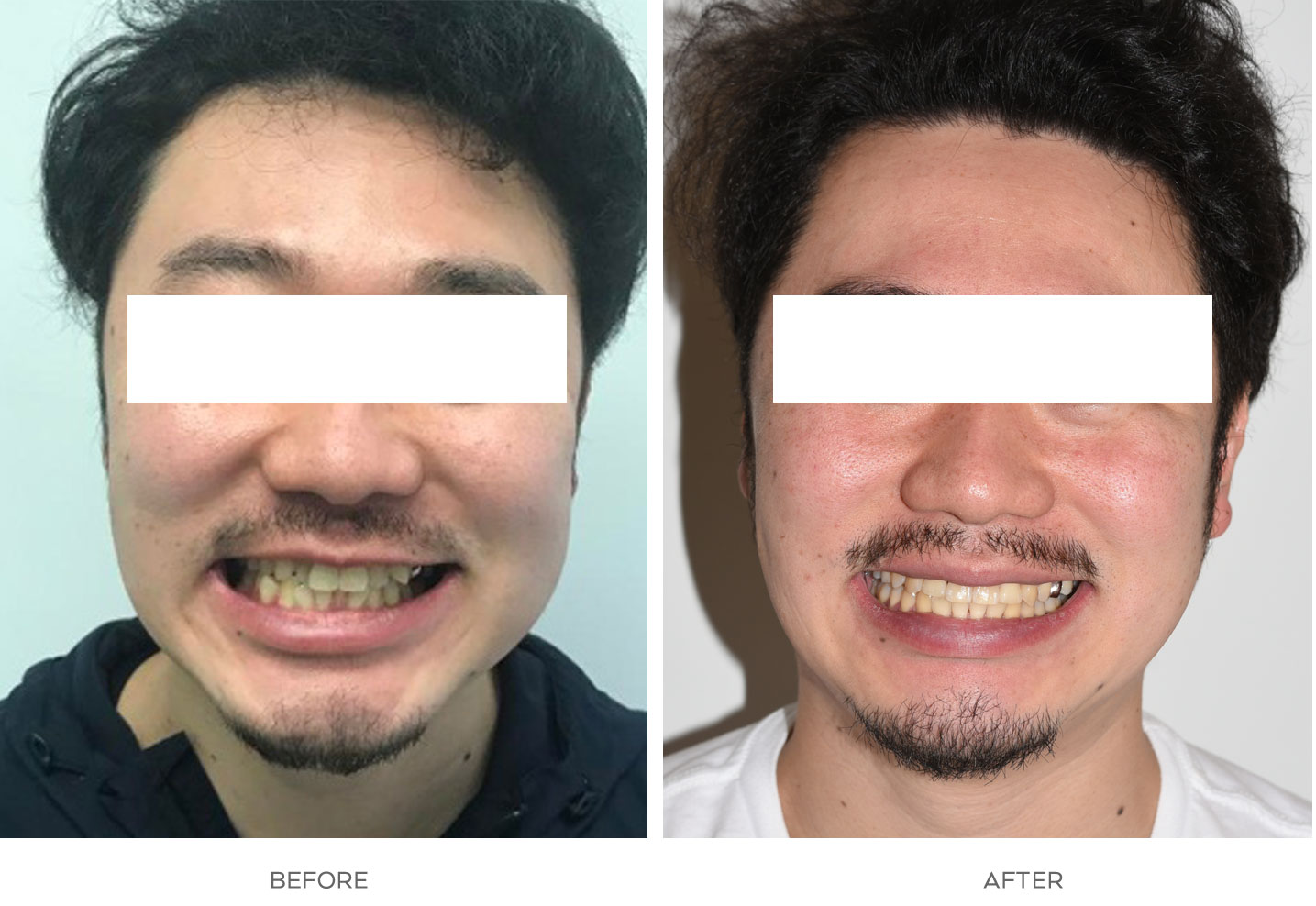 Best Invisalign in NYC | Creating Space with IPR and MSE