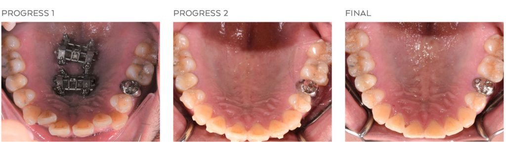 Best Invisalign in NYC | Creating Space with IPR and MSE