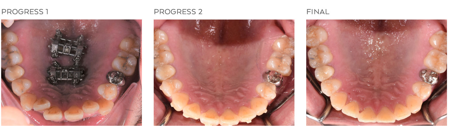 Best Invisalign in NYC | Creating Space with IPR and MSE