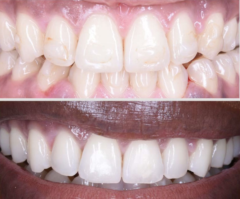 INVISALIGN® - Dr. Lena Dentistry