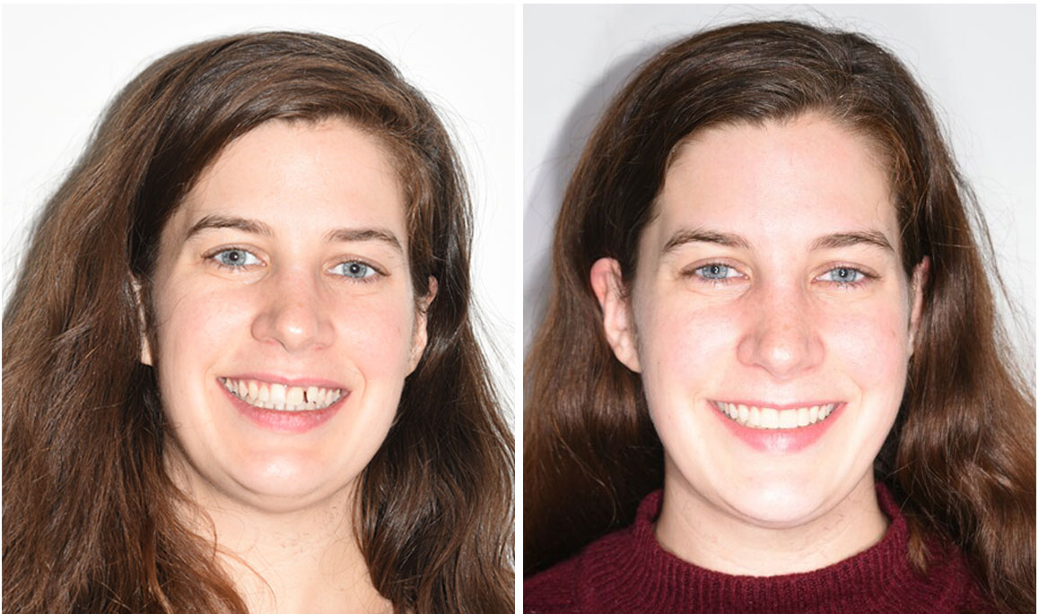 Chronic TMJ - Dr. Lena Dentistry